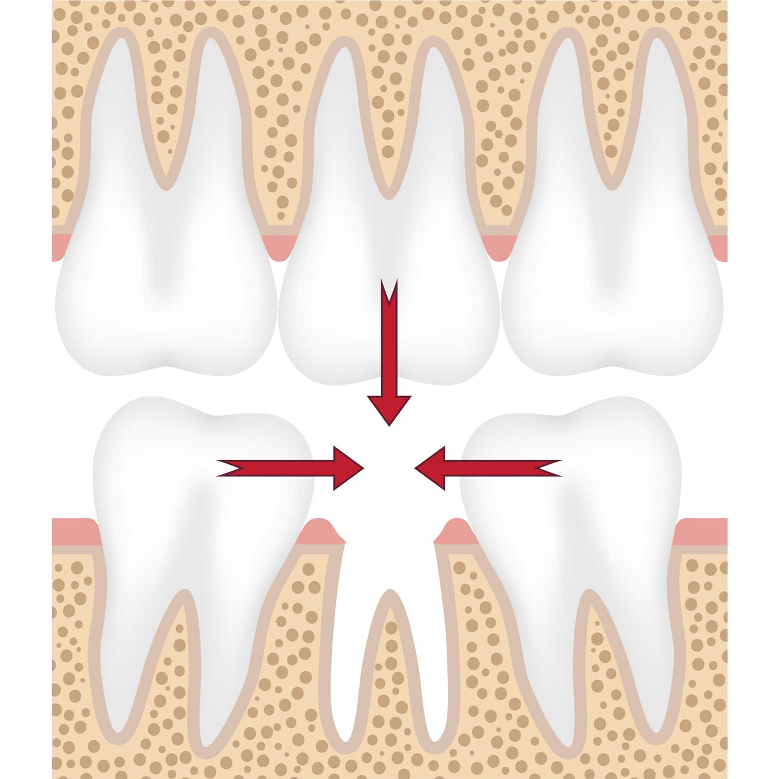 Extraction Site Preservation with Bone Graft – Bowie, MD Dentist ...